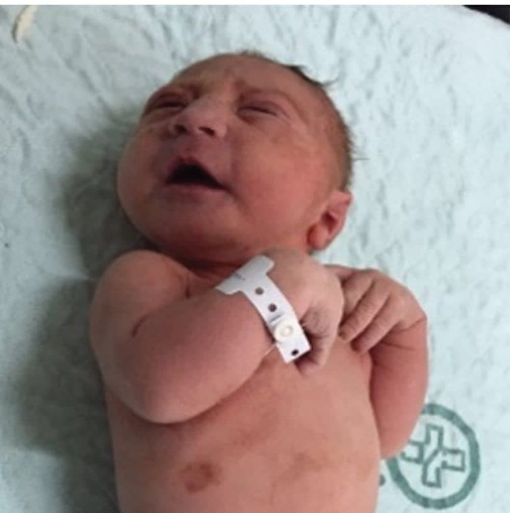 New Images Of Baby Brain Scans Show Extensive Damage From Zika | Radio ...