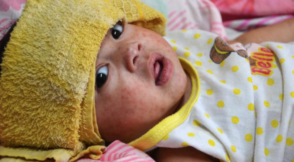 'Immune Amnesia': Why Measles Is Dangerous For Years After Catching It ...